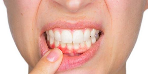 Entzündung des Zahnfleisches - Erkennen und Behandeln