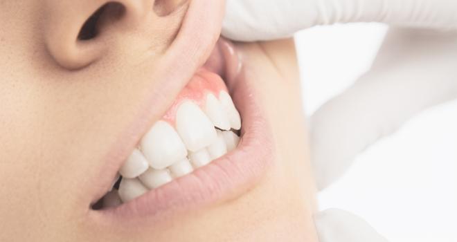 Entzündung des Zahnfleisches