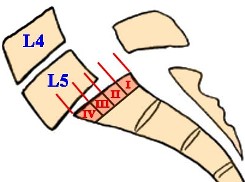 Diagnose einer Spondylolisthesis